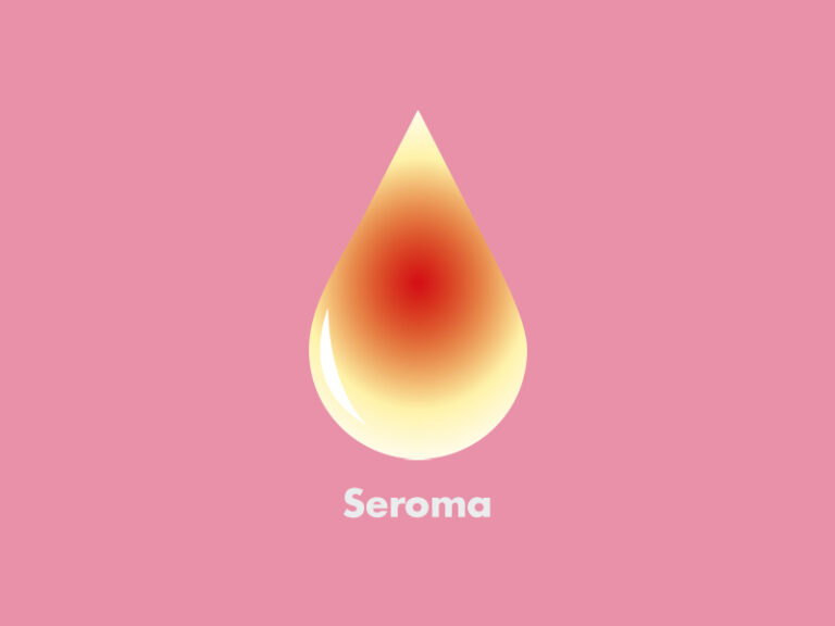 Seroma: como identificar, tratar e evitar o acúmulo de líquidos