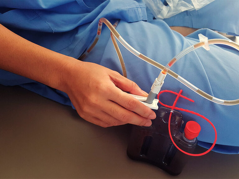 Seroma após a cirurgia é normal? | Dream Plastic