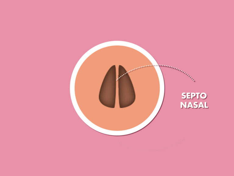 Cranio De Septo Nasal