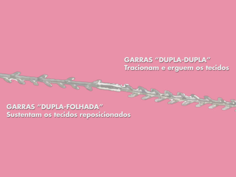 Fios de Sustentação - Tipos, quando usar, preço e cuidados