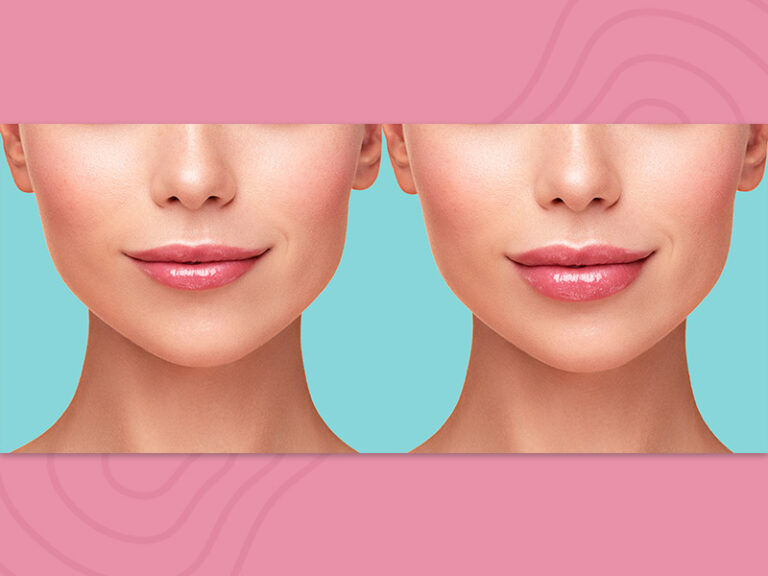 Preenchimento Labial Como é Feito Valor E Resultados Dream