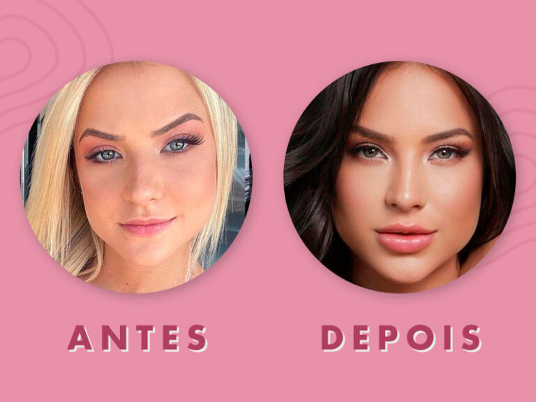 Preenchimento Labial Como é Feito Valor E Resultados Dream