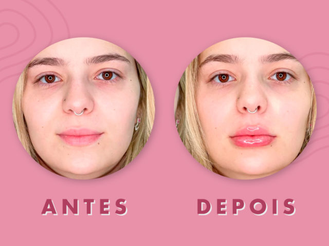 Preenchimento Labial Como é Feito Valor E Resultados Dream Plastic