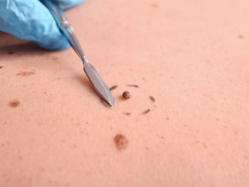 Como tirar pinta - tratamentos e resultados | Dream Plastic