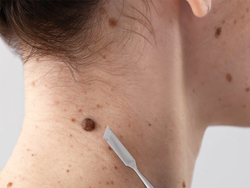 Como tirar pinta - tratamentos e resultados | Dream Plastic