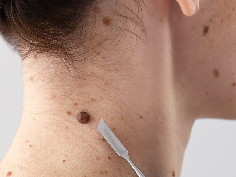 Como tirar pinta - tratamentos e resultados | Dream Plastic