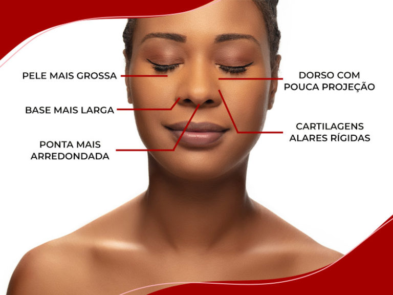 Nariz negroide - Preço da rinoplastia e como fica o antes e depois