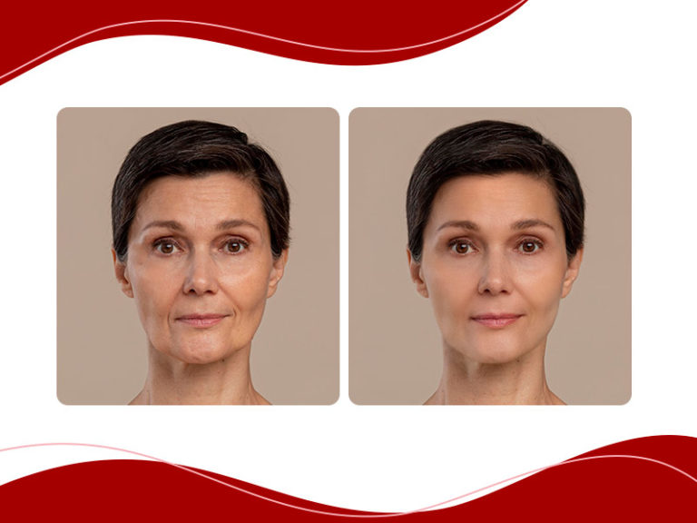 Endolifting - O que é e resultados | Dream Plastic