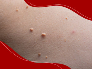 Tipos de Verrugas - Dream Plastic - Cirurgia Plástica SP