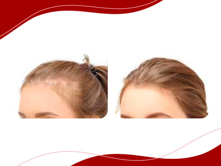 Microagulhamento capilar - Indicações e resultados