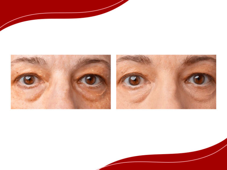 Xantelasma: Remova as Marcas e Resgate sua Beleza | Dream