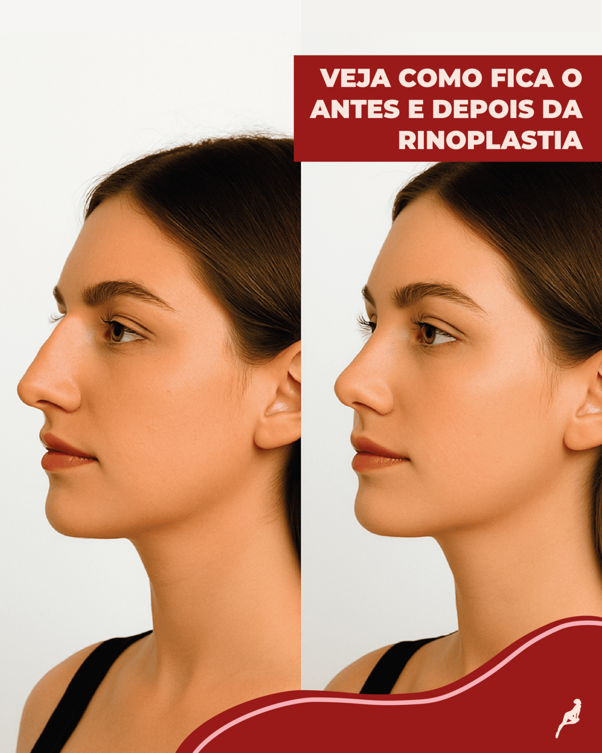 Rinoplastia: Como funciona e quando fazer